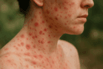 What Causes Red Spots on Neck? A Vital Guide to Common Triggers and ...